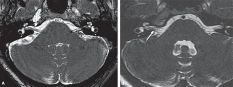 What Is A Vascular Loop Mri Anterior Inferior Cerebellar Artery Loop