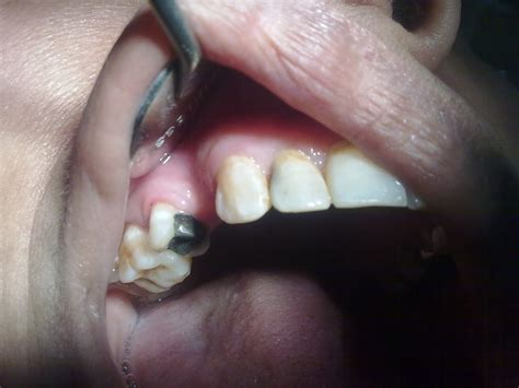 Dr Mohammed Arnous Class Iii Composite Restoration