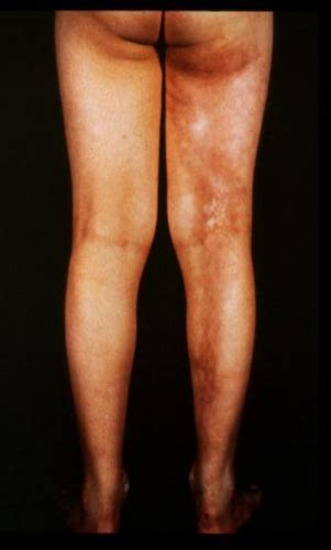 Scleroderma Crest Flashcards Quizlet