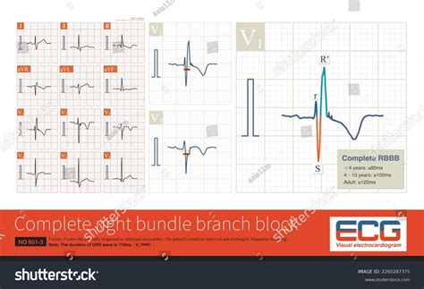 2009 American Aha Ecg Guidelines Defined Stock Illustration 2260287375 Shutterstock