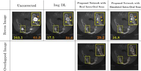 Comparison Of Metal Artifact Reduction With Clinical Cbct Data Image