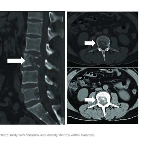 Local Relapse Free Survival LRFS For Patients With Scalp Sarcoma By