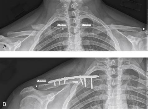 Open Reduction And Internal Fixation Of Clavicle Fractures
