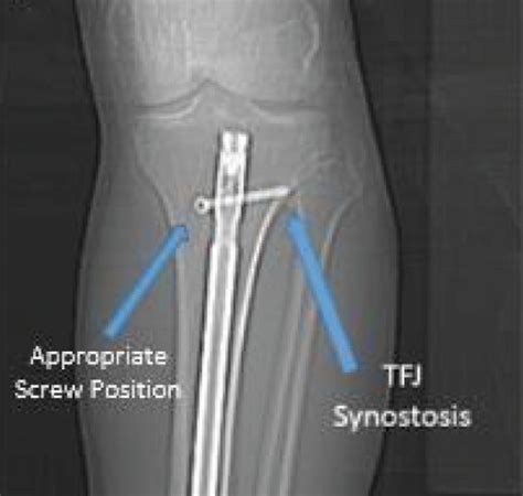 Proximal Tibiofibular Joint Synostosis A Ap X Ray Of The Left Download Scientific Diagram