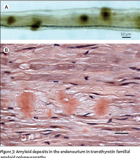 Figure 1 From Familial Amyloid Polyneuropathy Semantic Scholar