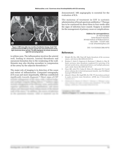 Solution Cavernous Sinus Thrombophlebitis Causing Reversible Narrowing