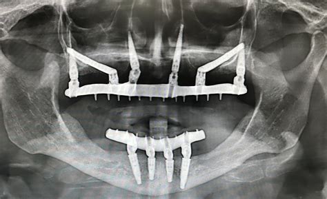 Zygoma Radiograph Dental