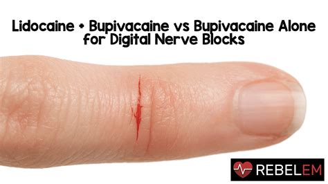 Lidocaine Bupivacaine Vs Bupivacaine Alone For Digital Nerve Blocks Rebel Em Emergency