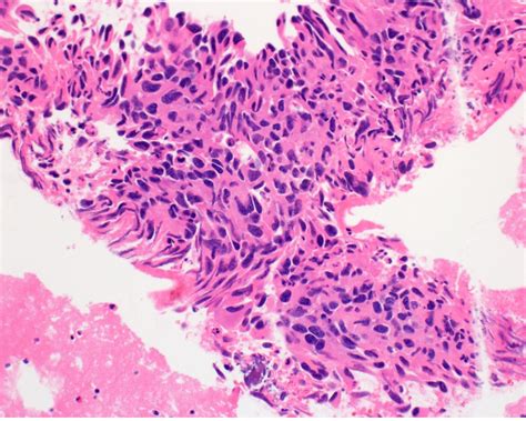 Pathology Outlines Angiosarcoma