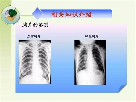 实战演练 基于深度学习训练模型正确识别肺炎x光图片 腾讯云开发者社区 腾讯云