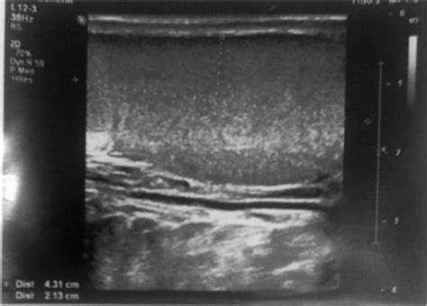 Ultrasound Picture Of The Testis Showed Normal Echogenicity Without Any