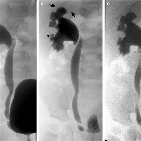 Observation Of Intrarenal Reflux By Age The Graphic Illustrates Near Download Scientific