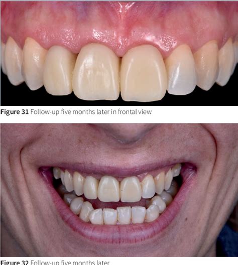 Figure 9 From Modified Procedure In A Socket Shield Technique In The Aesthetic Zone Case
