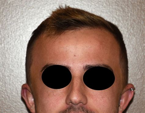 Young Male Temporal Reduction Front 2 Dr Barry Eppley Explore Plastic