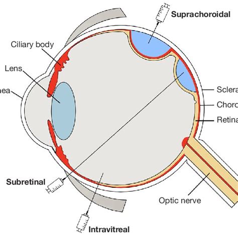 A Schematic Diagram Illustrating 3 Different Intraocular Injection Download Scientific Diagram