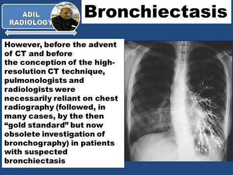 Bronchiectasis Plain Film Common Radiology Classroom