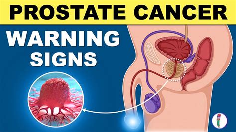 Prostate Cancer Signs Warning Signs Of Prostate Cancer YouTube