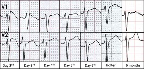 Dynamic Changes Of ECGs During Admission Download Scientific Diagram