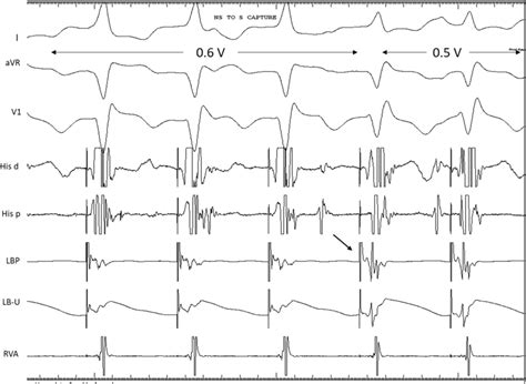 Demonstration Of Non Selective To Selective Left Bundle Branch Capture Download Scientific