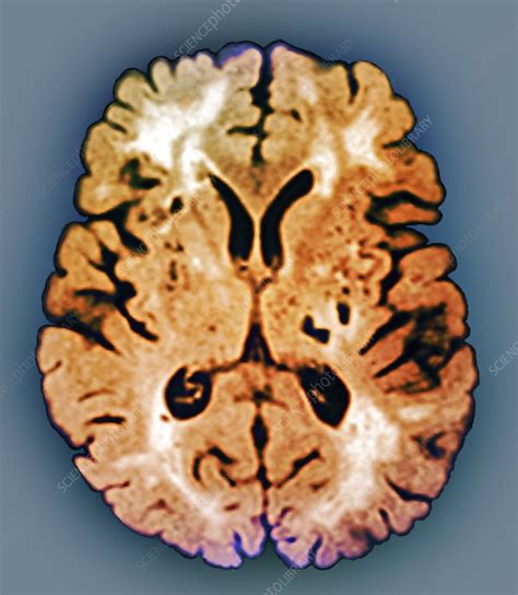 Cadasil Syndrome Mri Scan Stock Image C007 1975 Science Photo