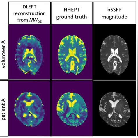 Example Of Dlept Reconstructions For Volunteer A And Patient A Using Download Scientific