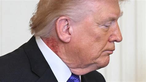 Does Trump Have A Shingles Rash On His Neck What His Doctor Says