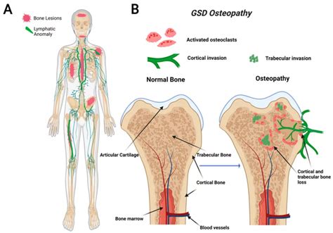 Gorham Stout Disease Causes Symptoms And Diagnosis
