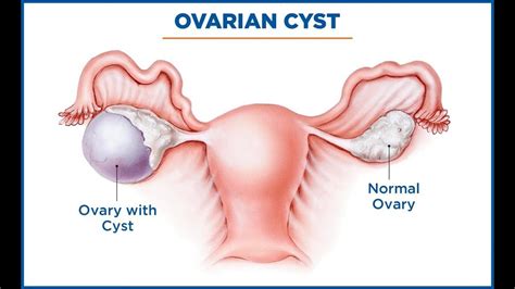 Ovarian Cystectomy Cpt Code Simplify Medical Coding Youtube
