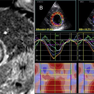 A Phase Sensitive Inversion Recovery Sequence Left Ventricular Short Download Scientific