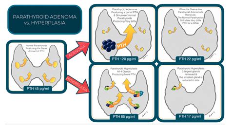 Parathyroid Adenoma And Parathyroid Hyperplasia Hyperparathyroidism
