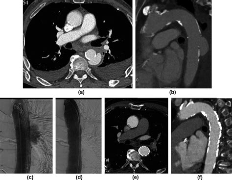 Mycotic Aortic Aneurysm Staged Hybrid Management Of A Mycotic