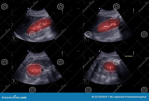 Ultrasound Of Urinary Bladder Or Kub For Screening Renal And Bladder Disease Stock Image