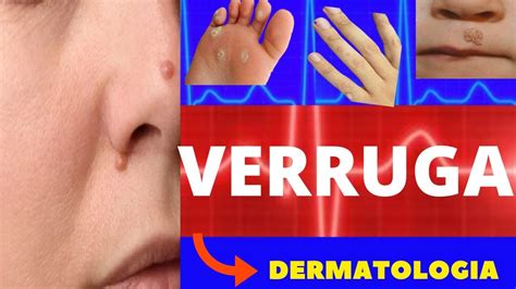 Verrugas De Pele Causa Sintomas DiagnÓstico E Tratamento