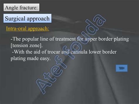Fracture Mandibular Angle Ppsx Fracture Mandibular Angle Ppsx