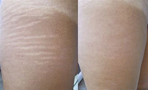 Come Togliere Le Smagliature Dopo Il Dimagrimento