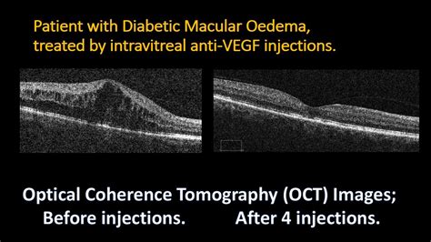 Antivegf Intravitreal Injections Given By Non Medical Healthcare Practitioners