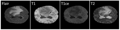 Unsupervised Tumor Aware Distillation For Multi Modal Brain Image