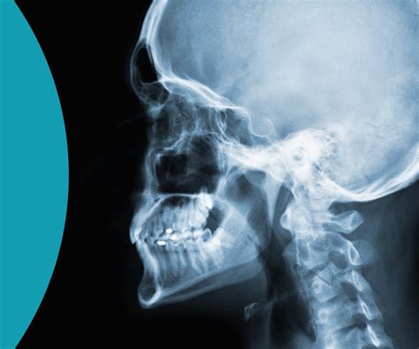 Radical Neck Dissection Head And Neck Surgery London