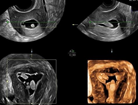 Transvaginal Ultrasound Uterine Cancer Clear Cell Carcinoma Of The