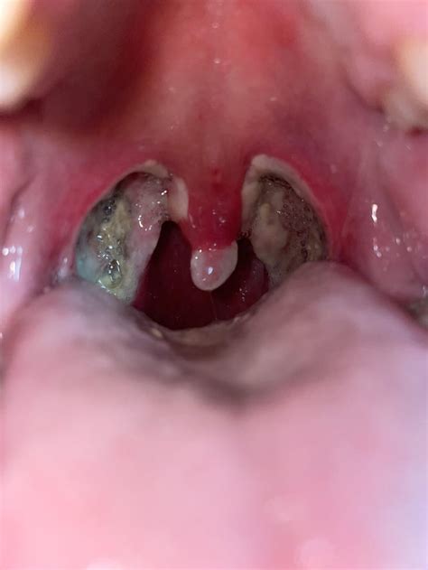 Saw Someone Else Post A Tonsillectomy Pic So Heres The First 14 Days Of My Tonsillectomy