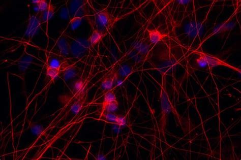 New Genetic Clues To Frontotemporal Dementia Neuroscience News