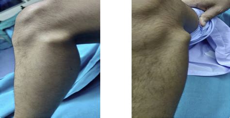 Clinical Pictures Showing Prominence Of The Fibular Head Download