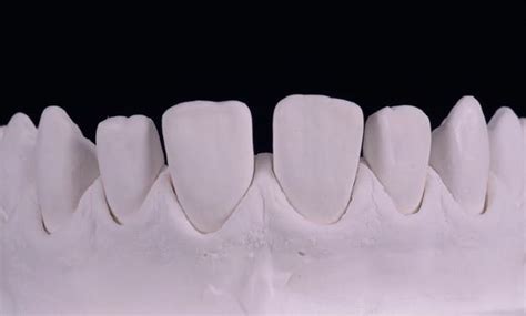 Digital Design Of A Smile Taking Into Account The Configuration Of The Face Aboutsoft Org
