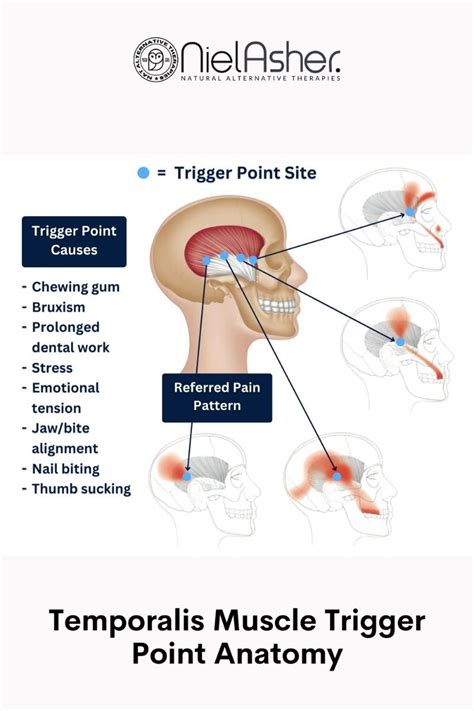 Trigger Point Therapy Treating Gluteus Medius And Minimus Artofit