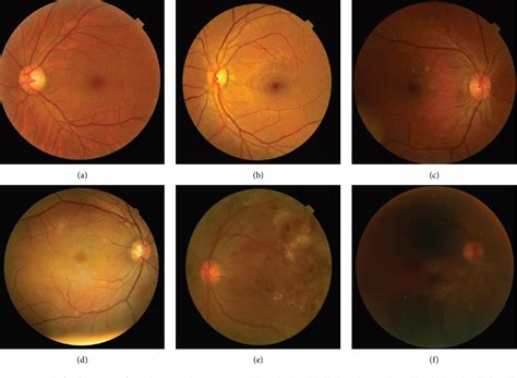 Figure 2 From Classification Of Diabetic Retinopathy Severity In Fundus Images Using The Vision