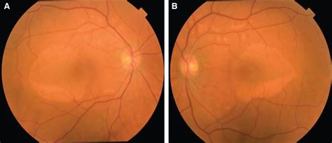 Acute Exudative Polymorphous Vitelliform Maculopathy Ento Key
