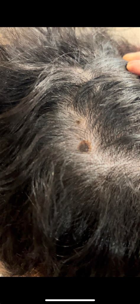 Please Help Is This Mole Cancerous Looking Rmelanoma