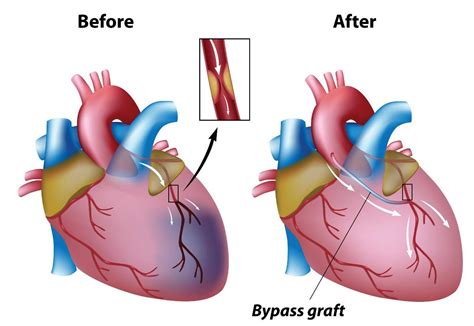 Coronary Artery Bypass Graft Surgery CABG Cardiovascular