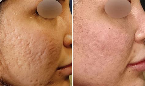 Exo Hl Exosome For Acne Scars What To Expect In Malaysia Millennium