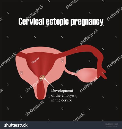 Development Embryo Cervix Ectopic Pregnancy Infographics ภาพประกอบ